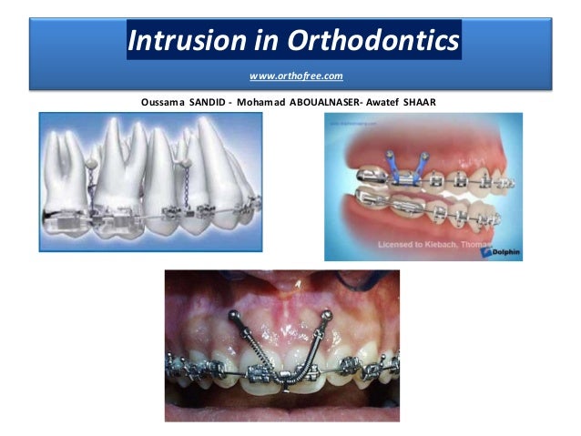 117 intrusion in orthodontics-oussama sandid-mohamad aboualnaser-moha…
