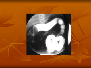 117742790 intususepsi-ppt | PPT