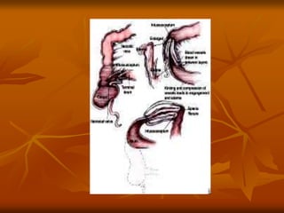 117742790 intususepsi-ppt | PPT