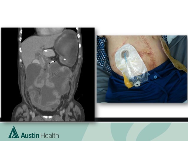 Intestinal Transplant: Overview and Australian Perspective | PPT