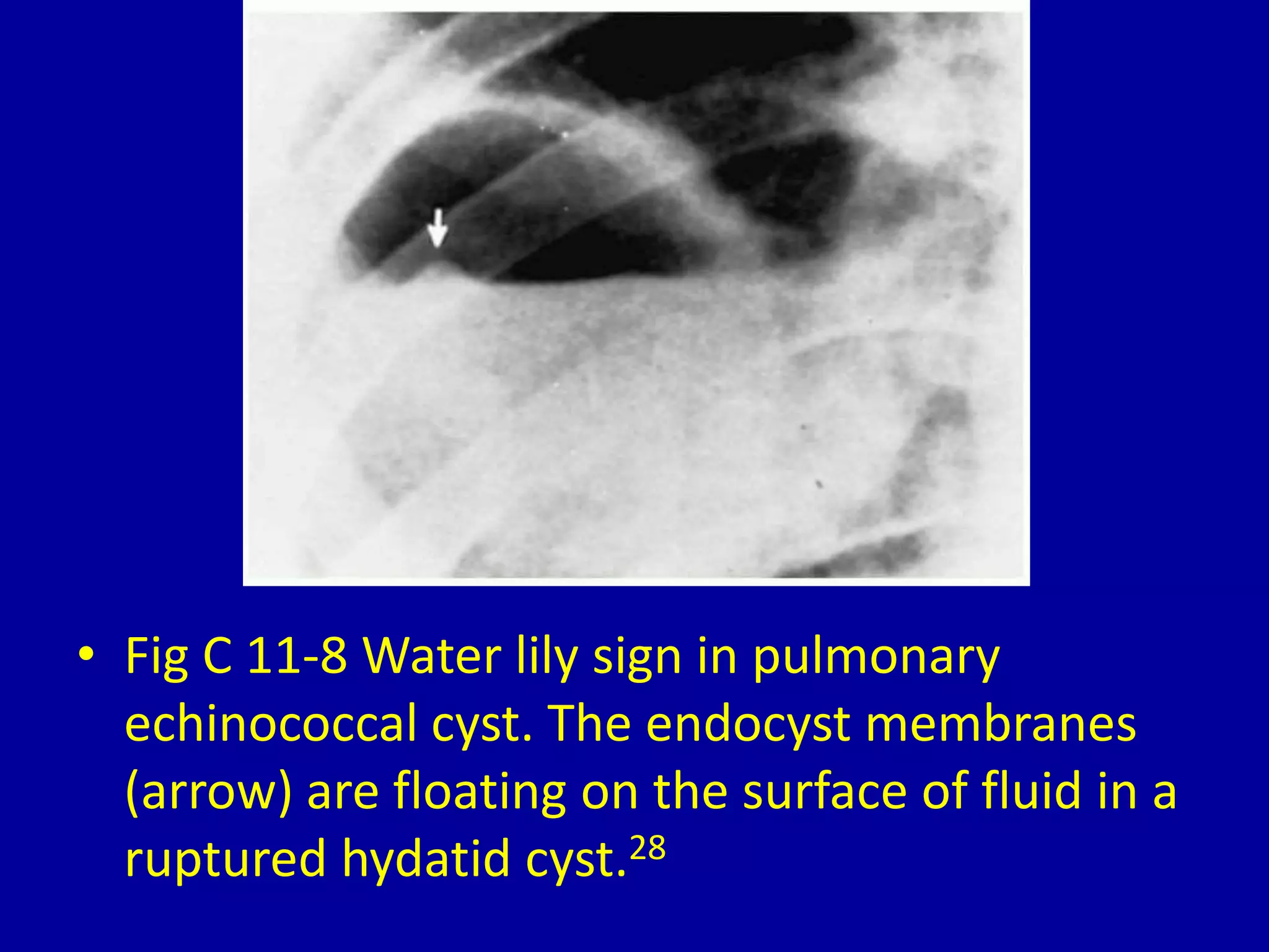 11 cavitary lesions of the lungs | PPTX