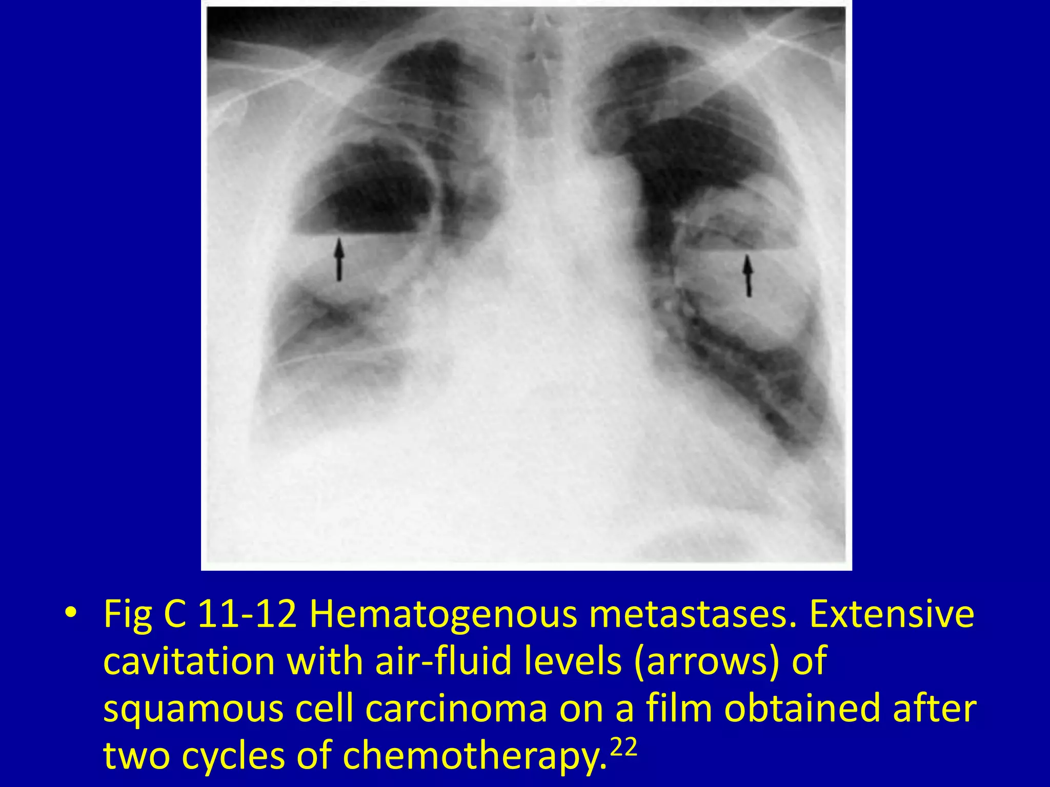 11 cavitary lesions of the lungs | PPTX