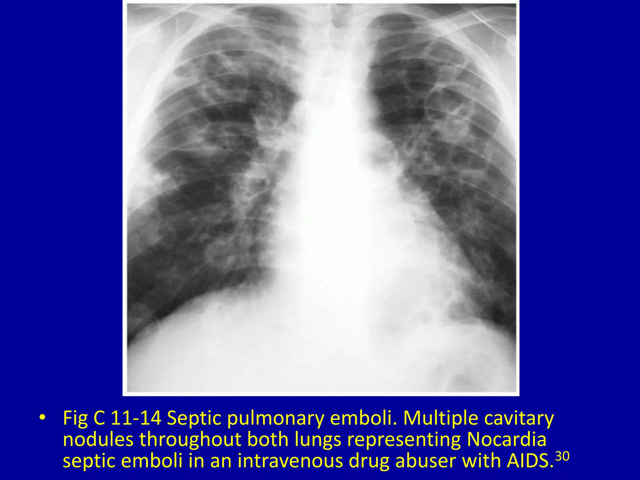 11 cavitary lesions of the lungs | PPTX