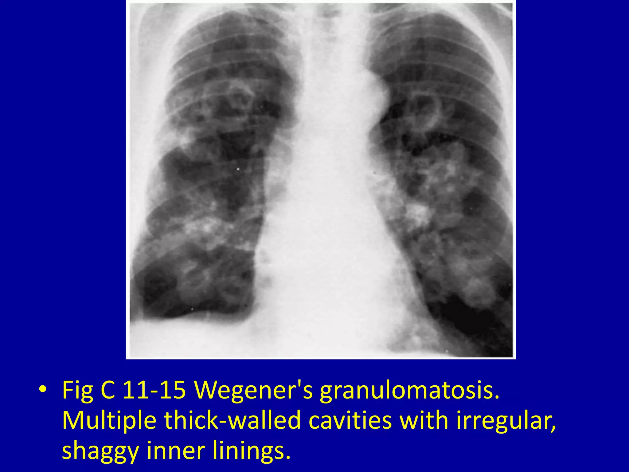 11 cavitary lesions of the lungs | PPTX