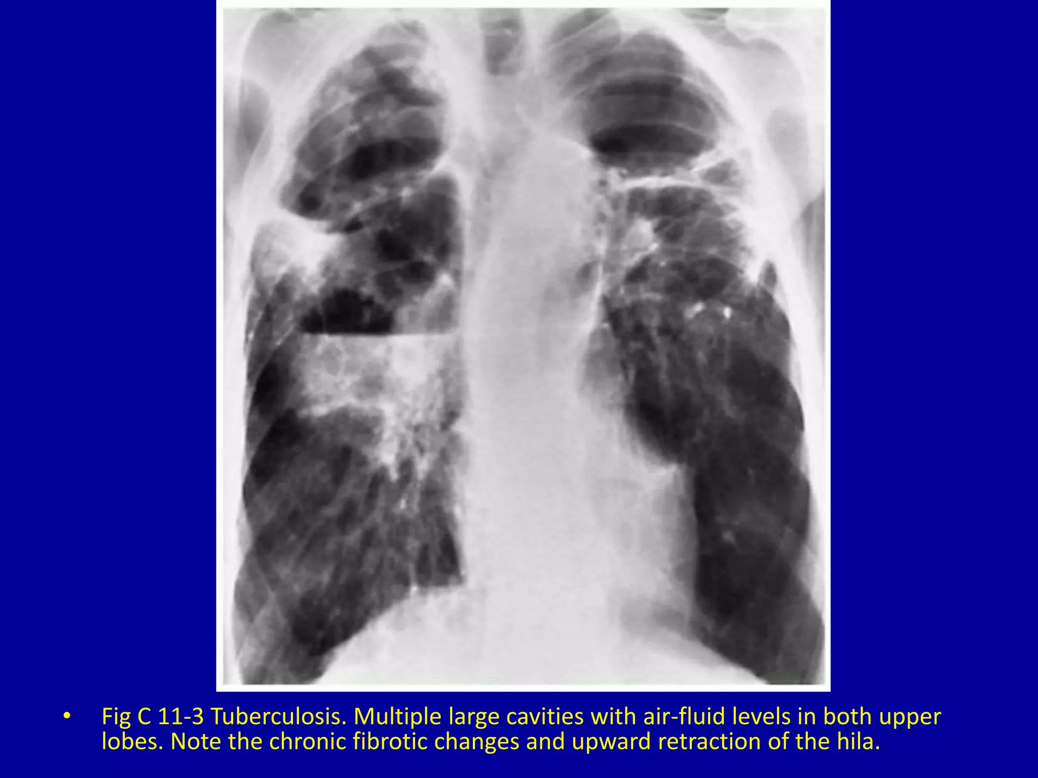 11 cavitary lesions of the lungs | PPTX