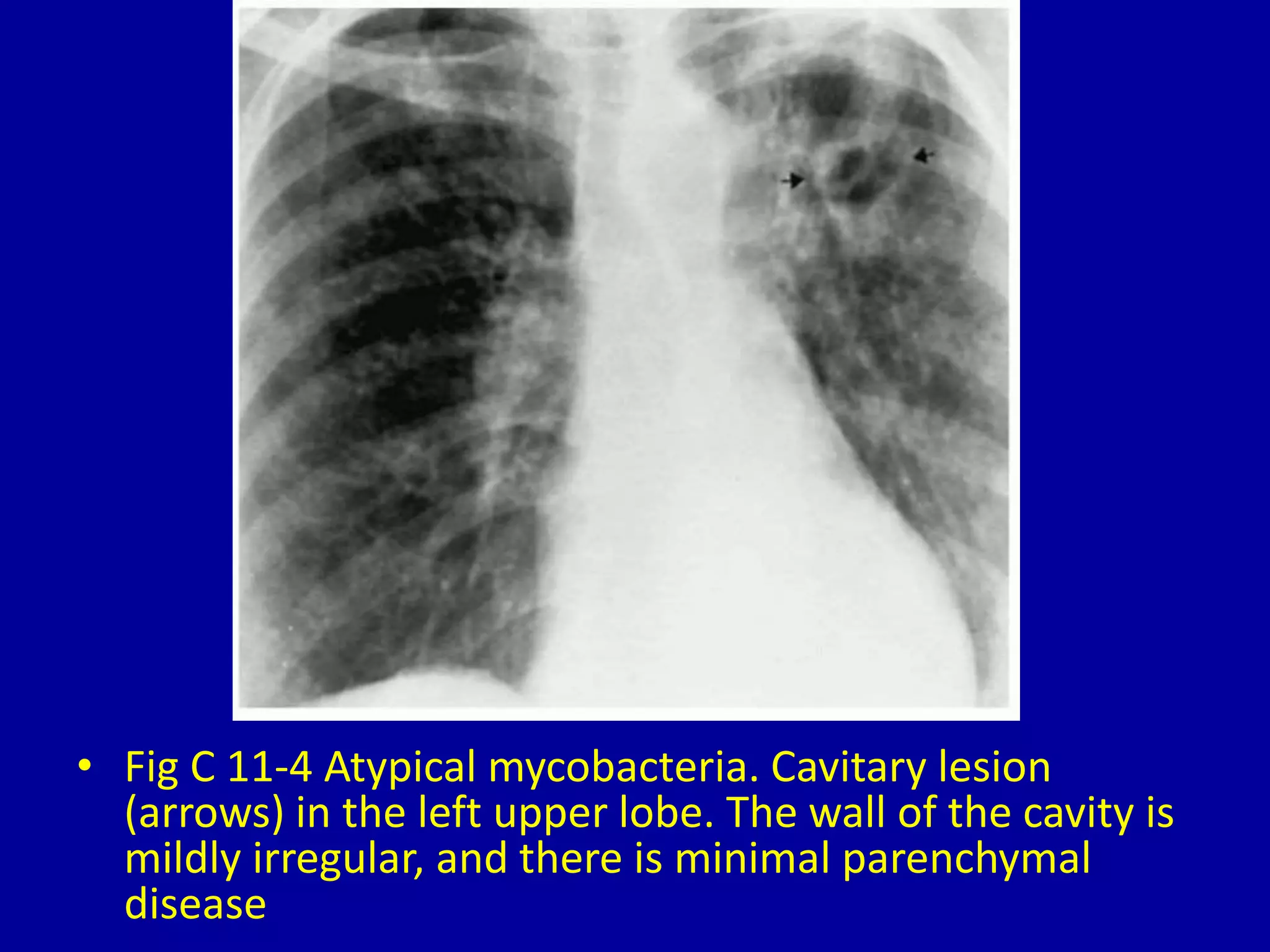 11 cavitary lesions of the lungs | PPTX