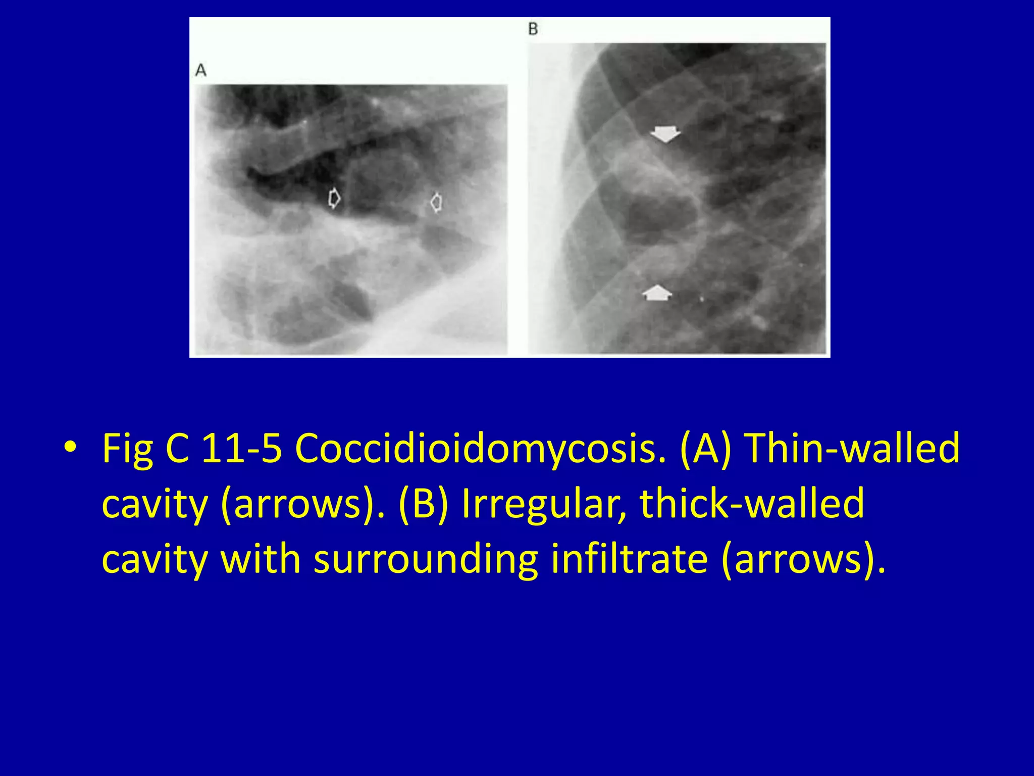 11 cavitary lesions of the lungs | PPTX