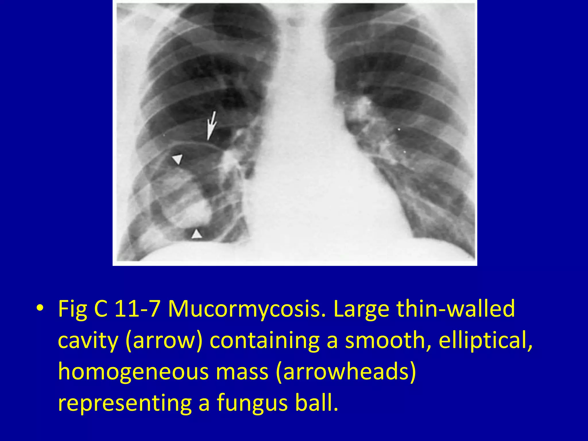 11 cavitary lesions of the lungs | PPTX
