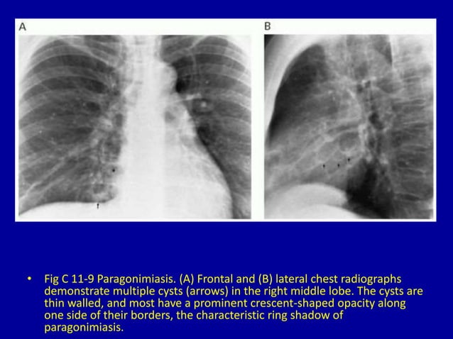 11 cavitary lesions of the lungs | PPTX