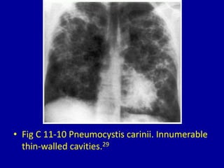 11 cavitary lesions of the lungs | PPTX
