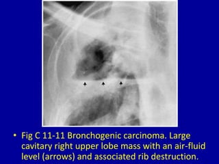 11 cavitary lesions of the lungs | PPTX