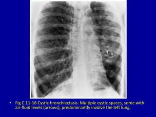 11 cavitary lesions of the lungs | PPTX