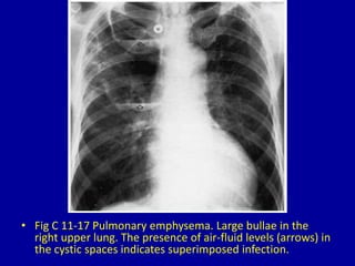 11 cavitary lesions of the lungs | PPTX