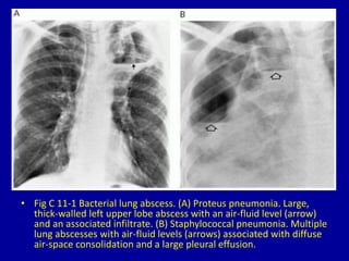 11 cavitary lesions of the lungs | PPTX