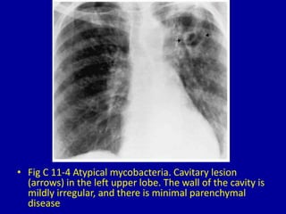 11 cavitary lesions of the lungs | PPTX
