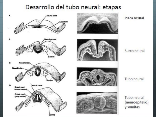 11 defectos del cierre del tubo neural
