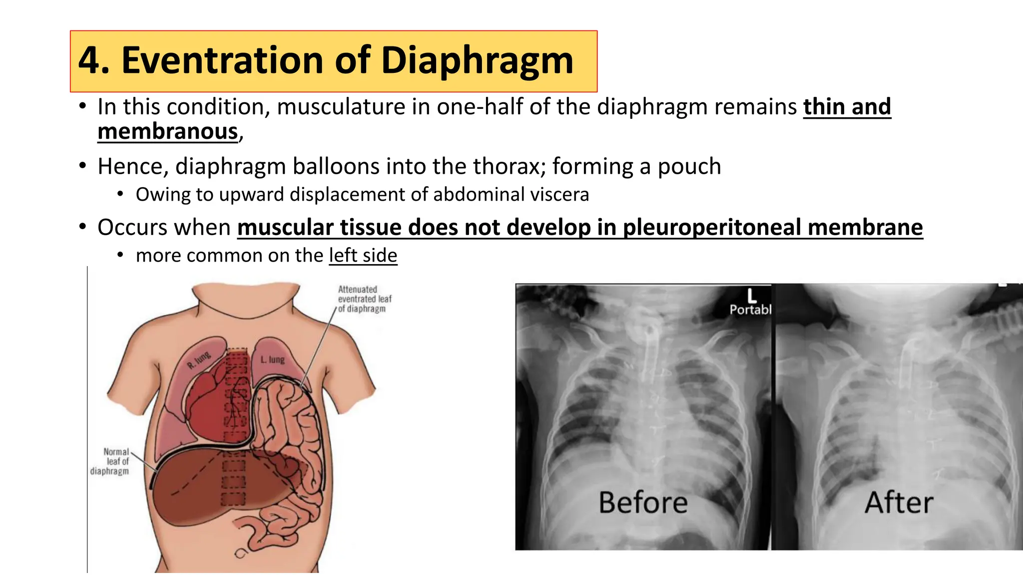 respiratorysy11_Dvt of the Diaphragm.pdf