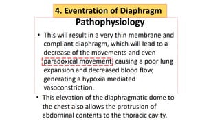 respiratorysy11_Dvt of the Diaphragm.pdf