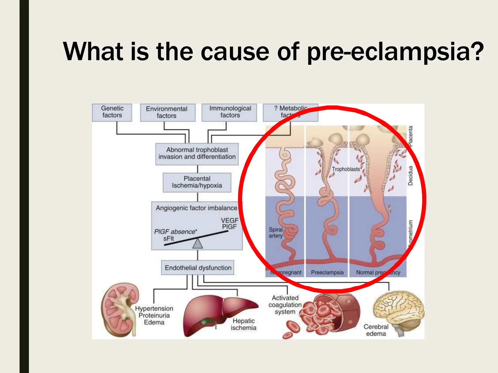 11_Eclampsia and preeclampsia real.pptxf | PPT