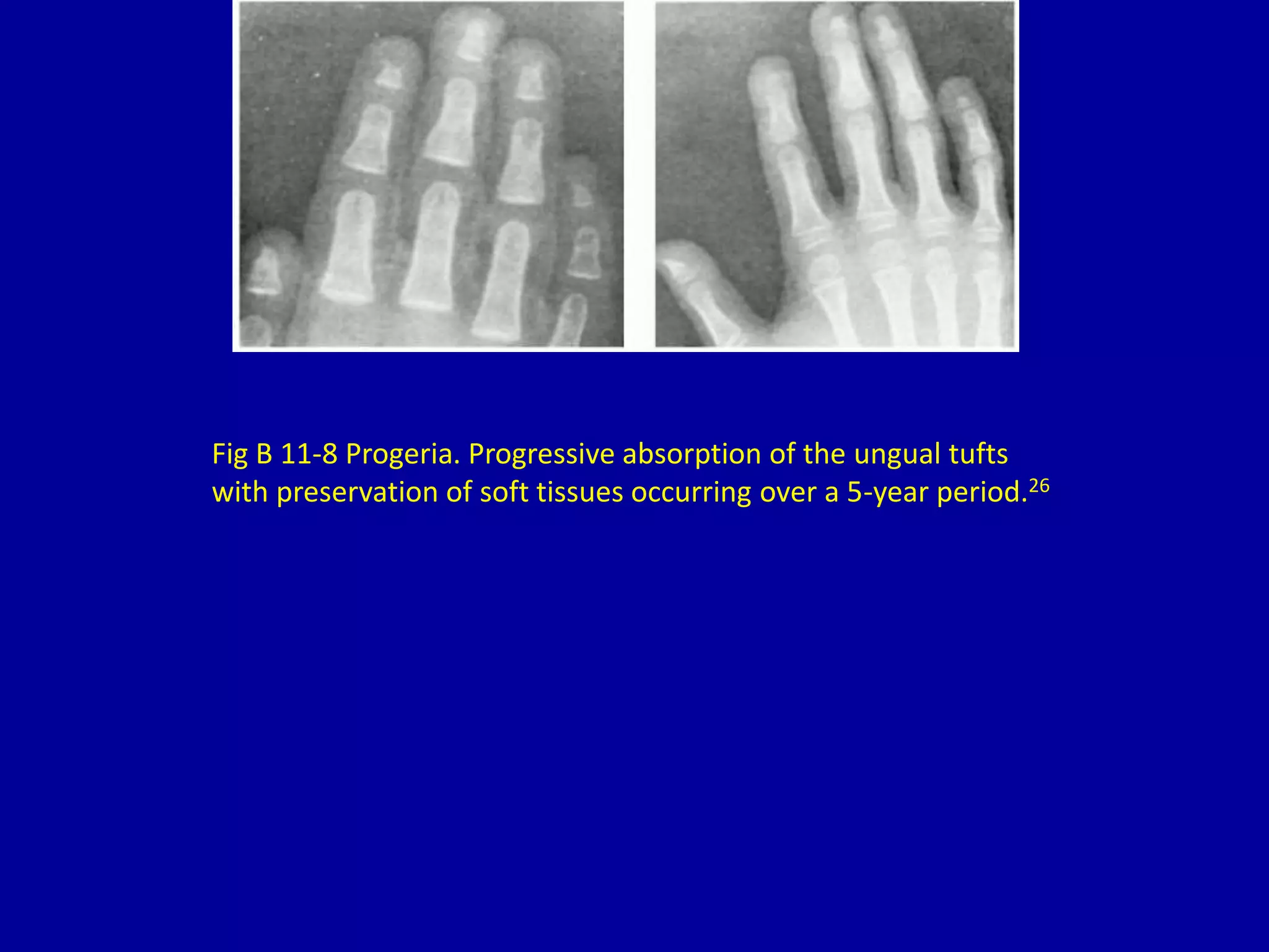 11 erosion of multiple terminal phalangeal tufts (ACROOSTEOLYSIS) | PPTX