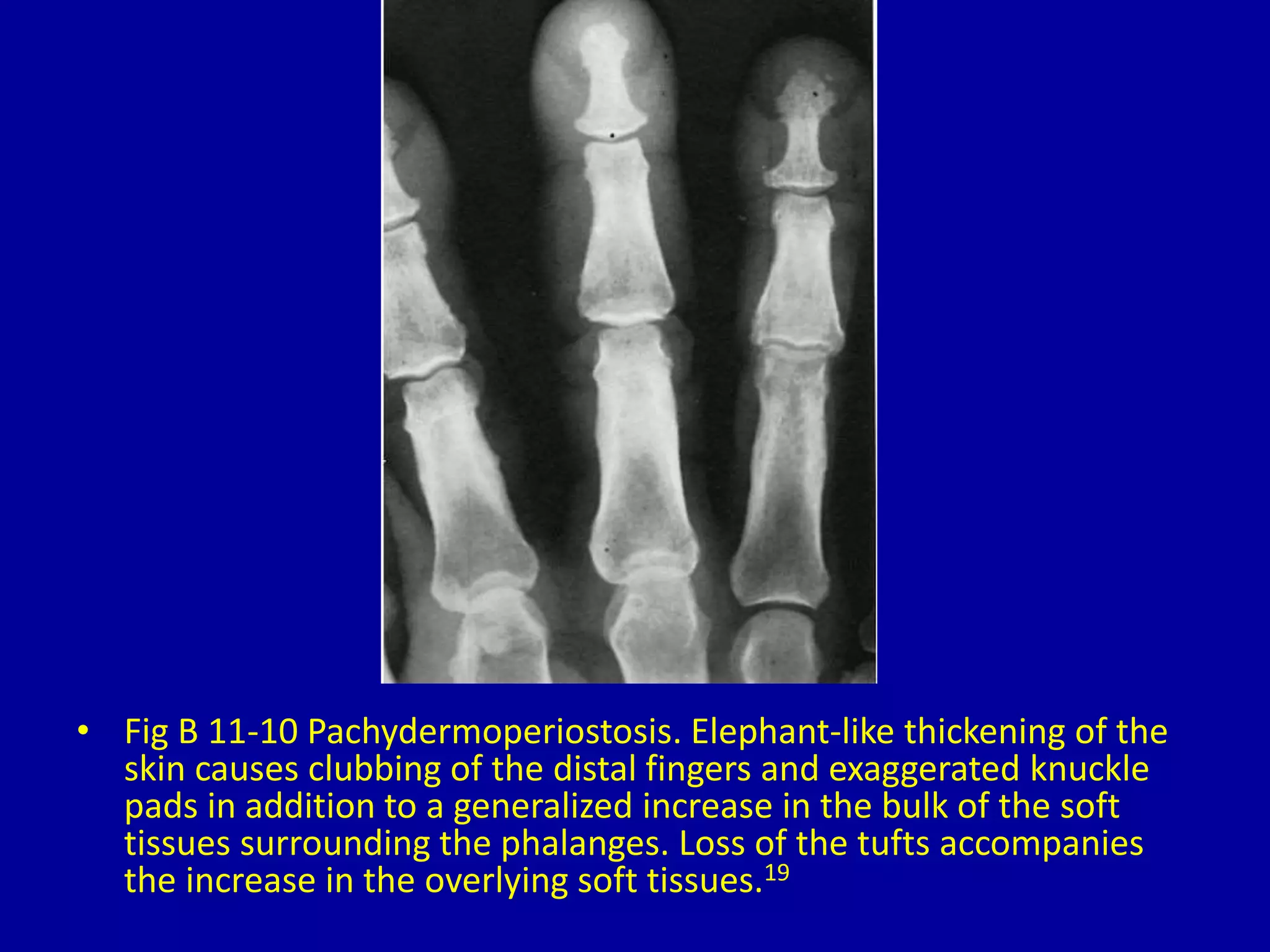 11 erosion of multiple terminal phalangeal tufts (ACROOSTEOLYSIS) | PPTX
