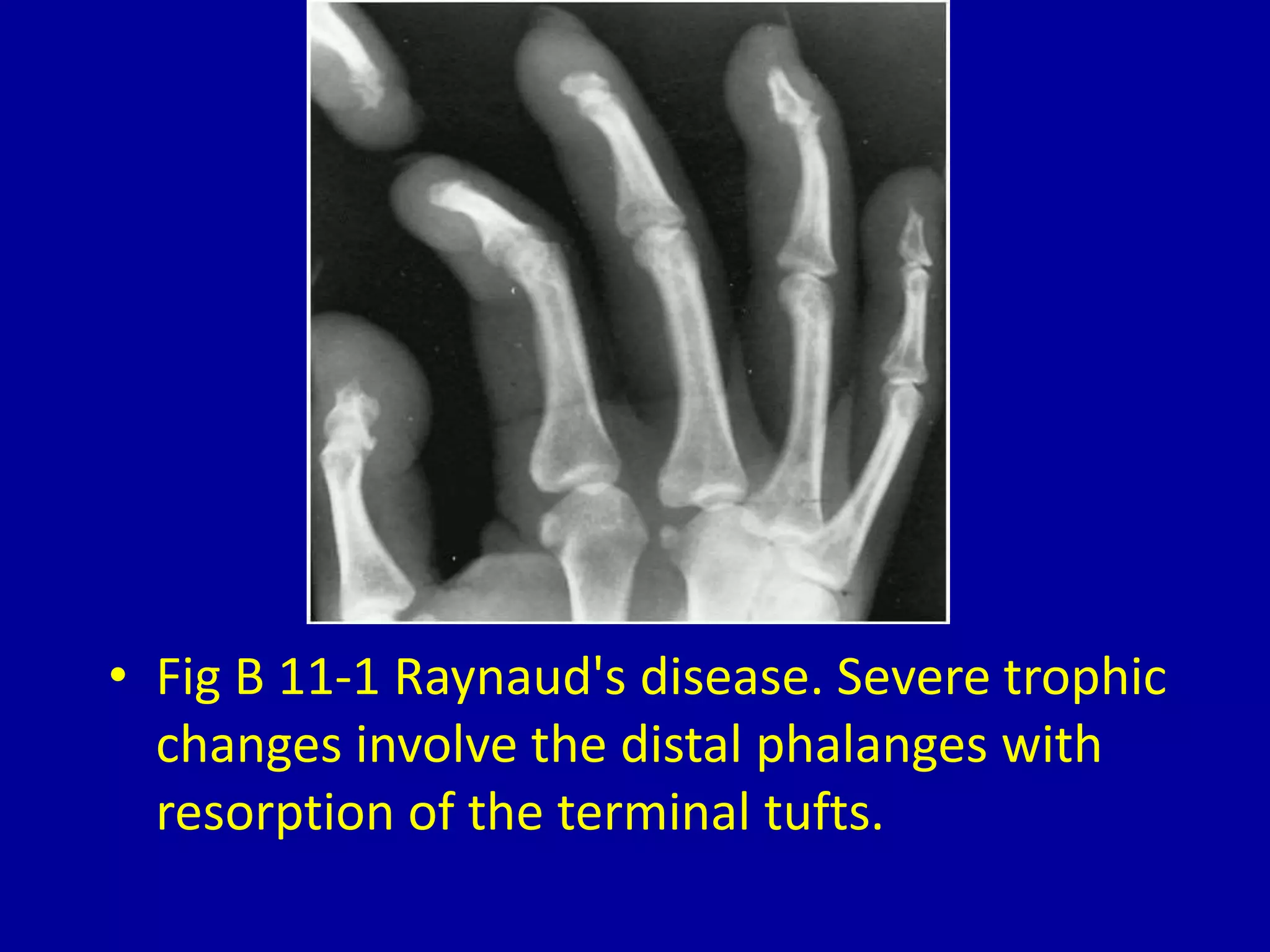 11 erosion of multiple terminal phalangeal tufts (ACROOSTEOLYSIS) | PPTX