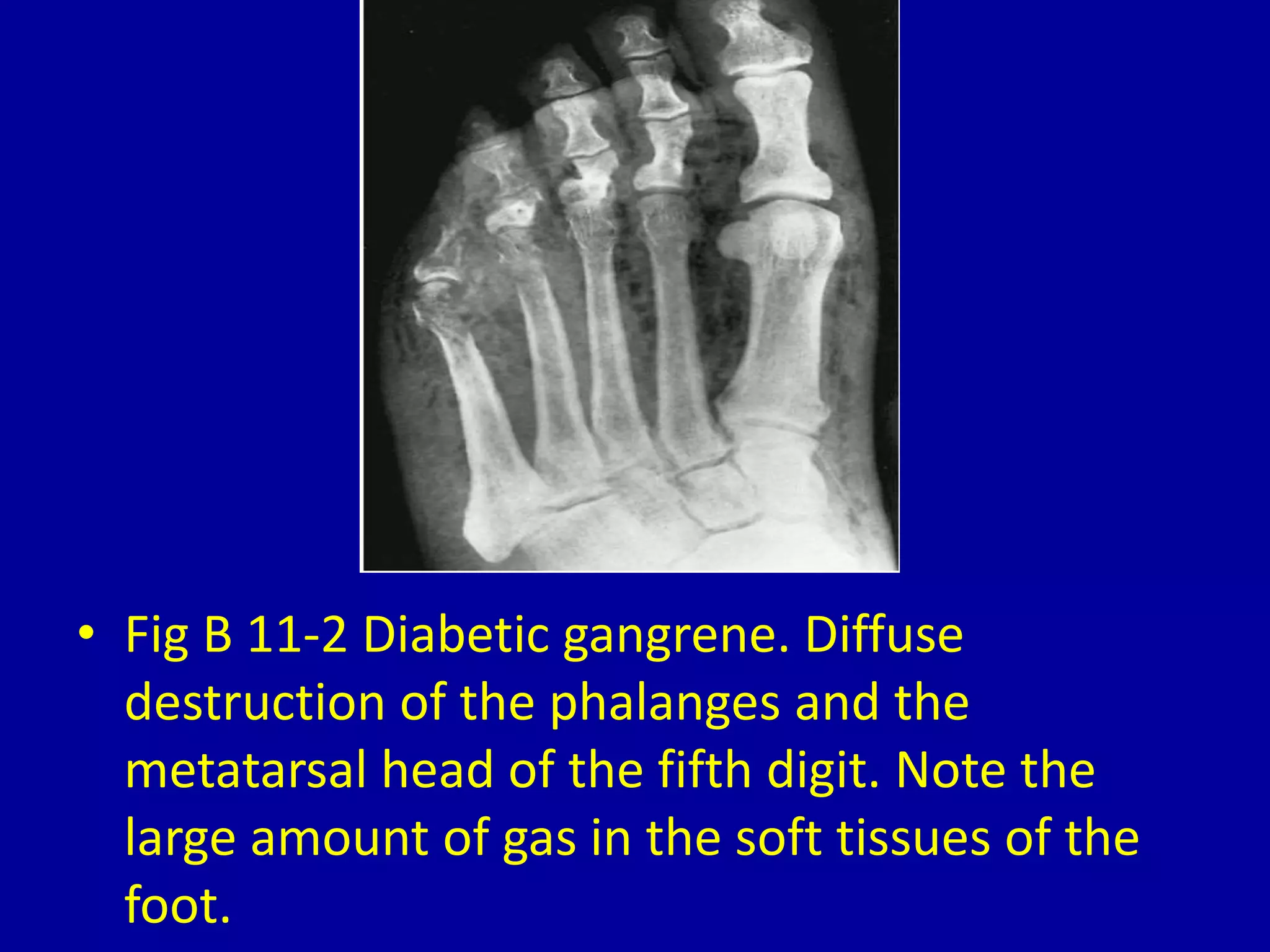 11 erosion of multiple terminal phalangeal tufts (ACROOSTEOLYSIS) | PPTX