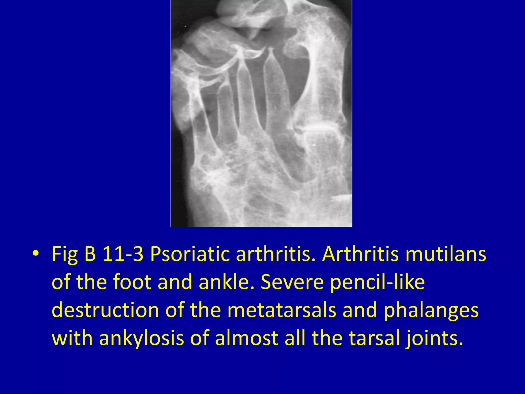 11 erosion of multiple terminal phalangeal tufts (ACROOSTEOLYSIS) | PPTX