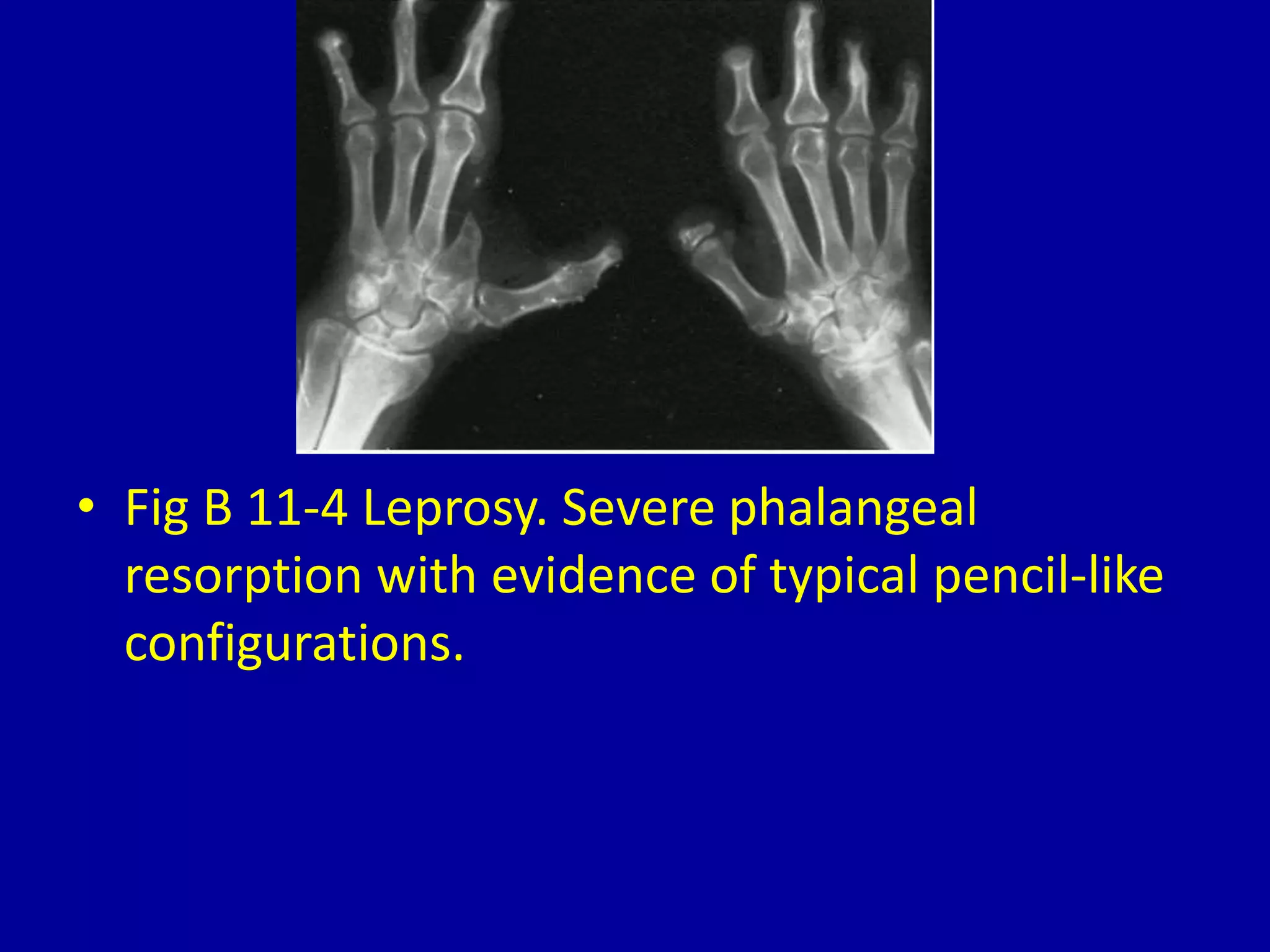 11 erosion of multiple terminal phalangeal tufts (ACROOSTEOLYSIS) | PPTX