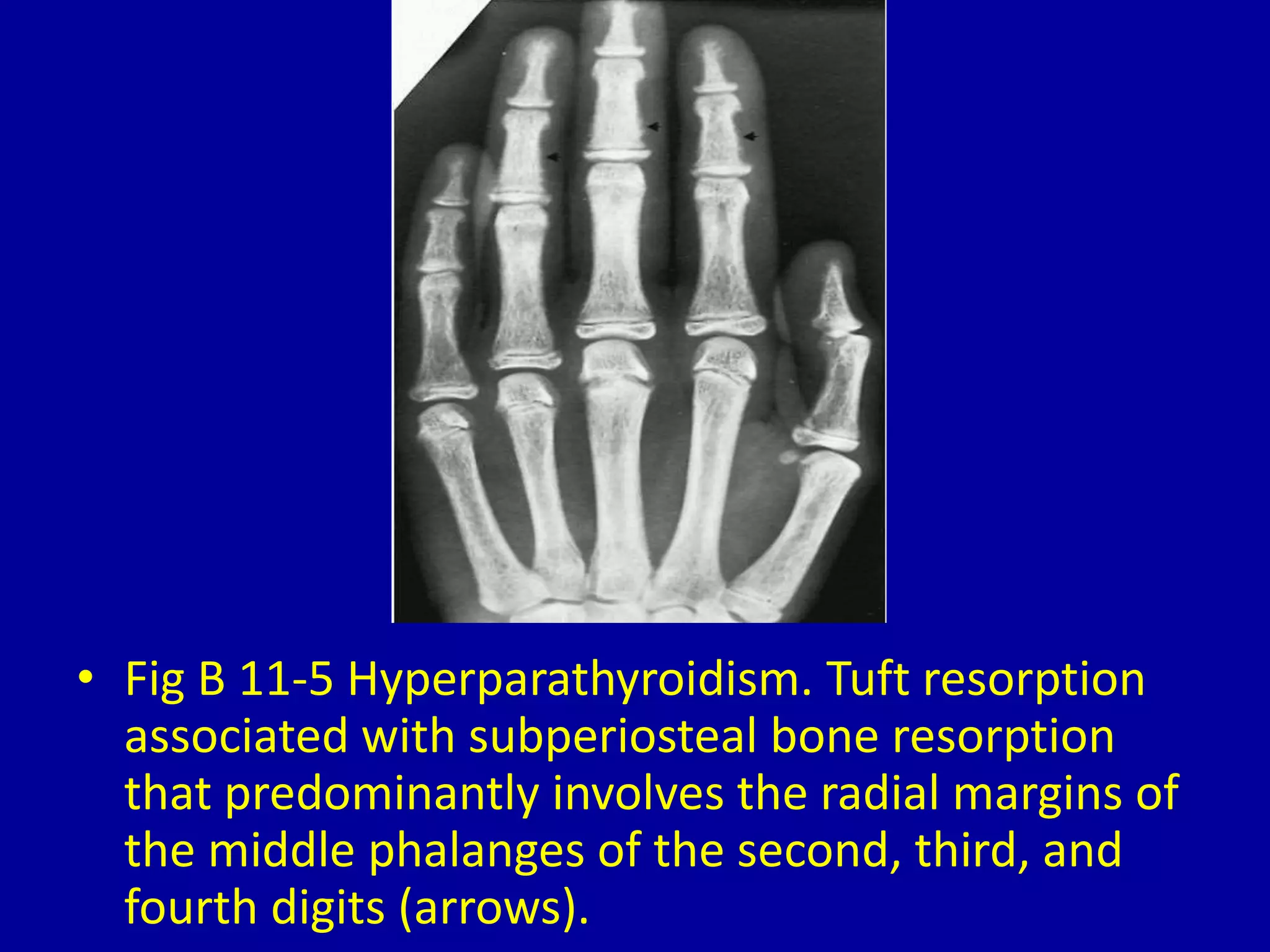 11 erosion of multiple terminal phalangeal tufts (ACROOSTEOLYSIS) | PPTX