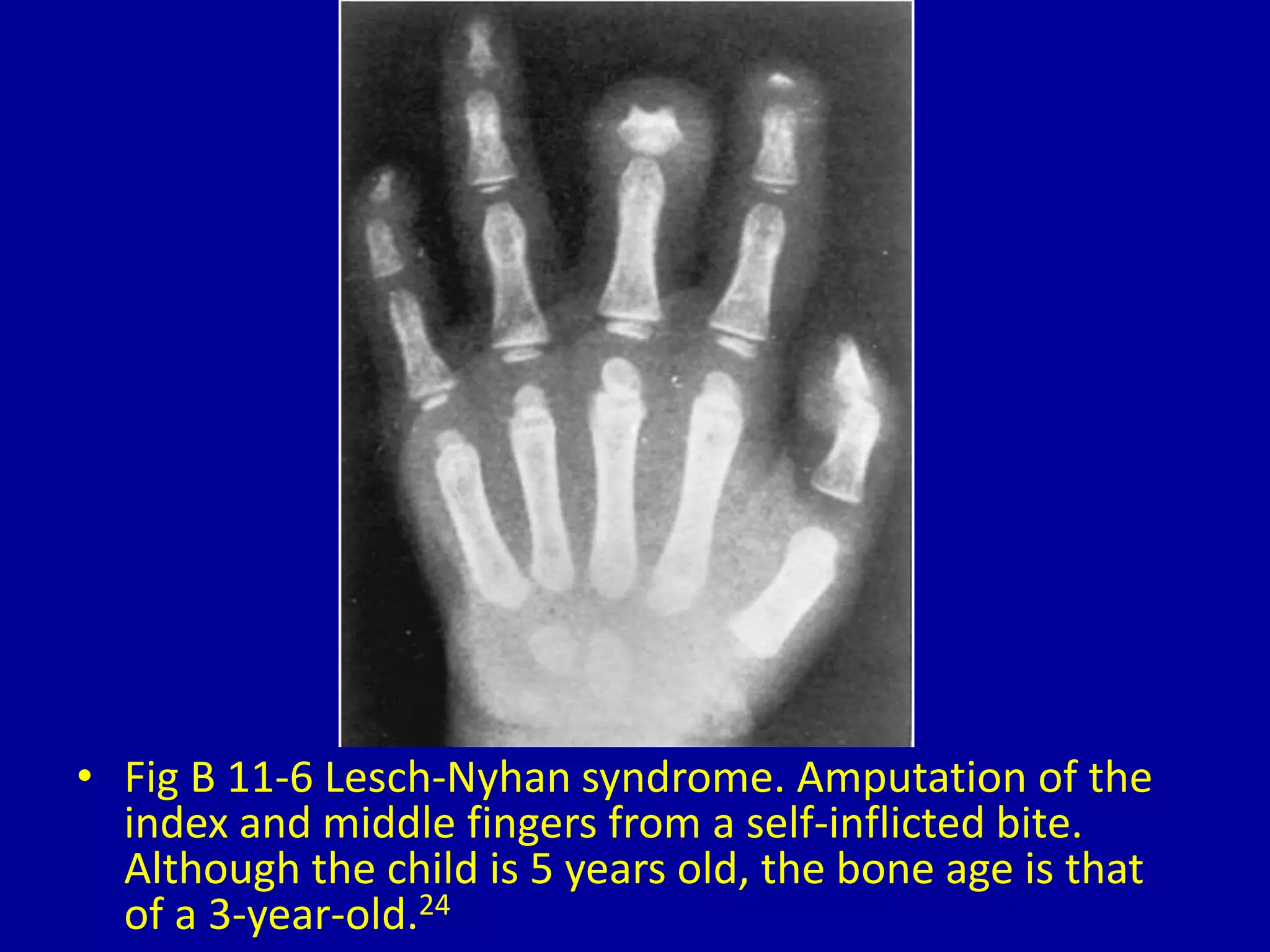 11 erosion of multiple terminal phalangeal tufts (ACROOSTEOLYSIS) | PPTX