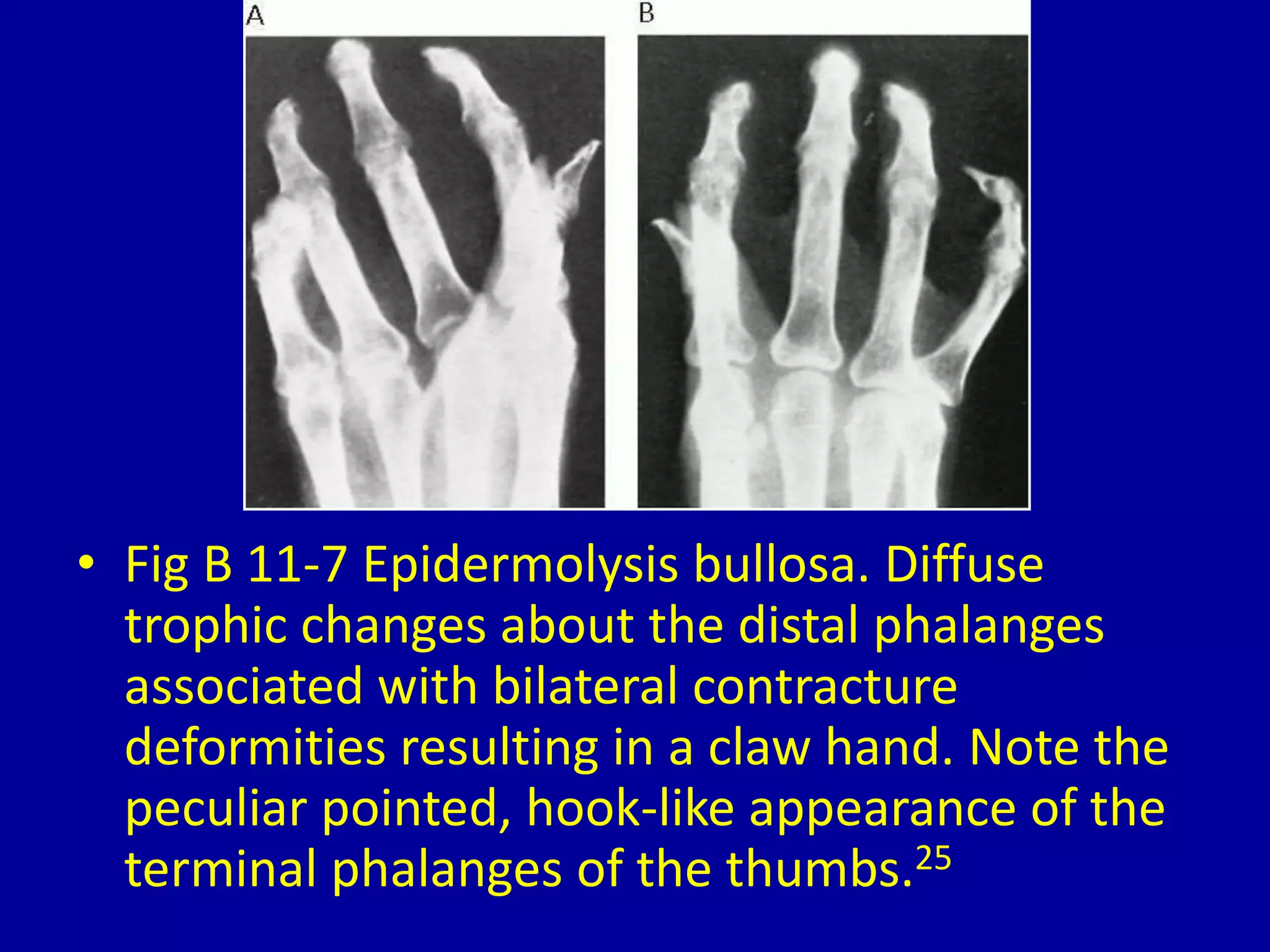 11 erosion of multiple terminal phalangeal tufts (ACROOSTEOLYSIS) | PPTX