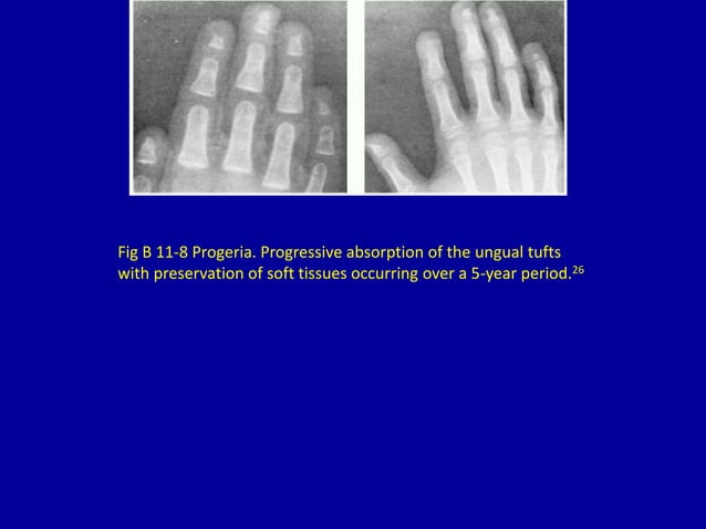 11 erosion of multiple terminal phalangeal tufts (ACROOSTEOLYSIS ...