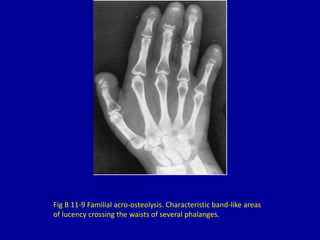 11 erosion of multiple terminal phalangeal tufts (ACROOSTEOLYSIS) | PPTX