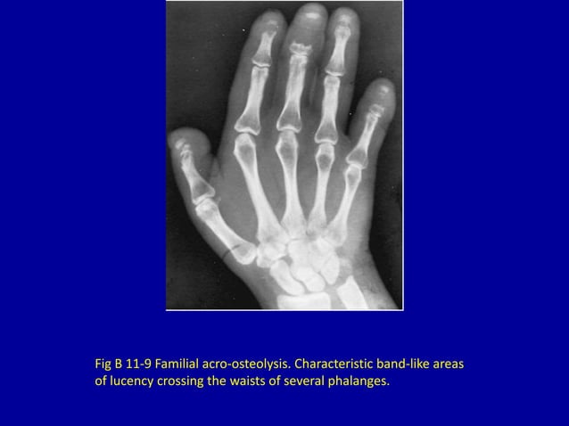 11 erosion of multiple terminal phalangeal tufts (ACROOSTEOLYSIS ...
