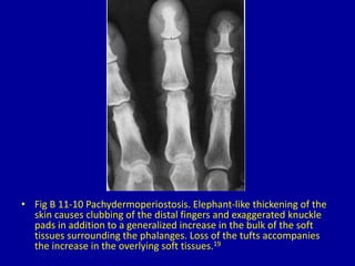 11 erosion of multiple terminal phalangeal tufts (ACROOSTEOLYSIS) | PPTX