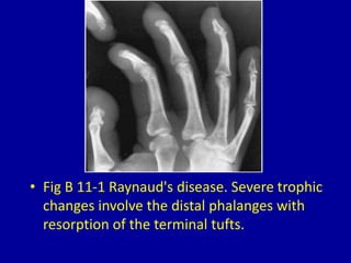 11 erosion of multiple terminal phalangeal tufts (ACROOSTEOLYSIS) | PPTX
