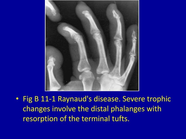 11 erosion of multiple terminal phalangeal tufts (ACROOSTEOLYSIS ...