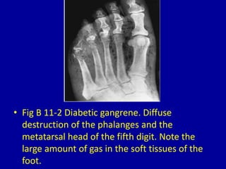 11 erosion of multiple terminal phalangeal tufts (ACROOSTEOLYSIS) | PPTX