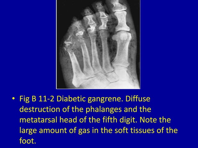 11 erosion of multiple terminal phalangeal tufts (ACROOSTEOLYSIS ...