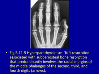 11 erosion of multiple terminal phalangeal tufts (ACROOSTEOLYSIS) | PPTX