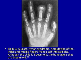 11 erosion of multiple terminal phalangeal tufts (ACROOSTEOLYSIS) | PPTX