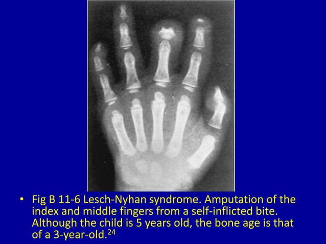11 erosion of multiple terminal phalangeal tufts (ACROOSTEOLYSIS ...