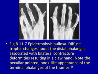 11 erosion of multiple terminal phalangeal tufts (ACROOSTEOLYSIS) | PPTX