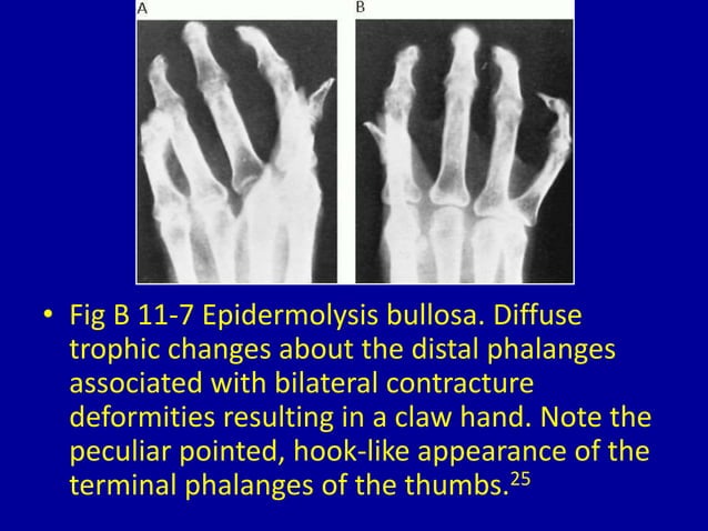 11 erosion of multiple terminal phalangeal tufts (ACROOSTEOLYSIS ...