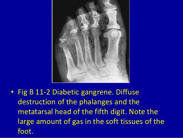 11 erosion of multiple terminal phalangeal tufts (ACROOSTEOLYSIS)