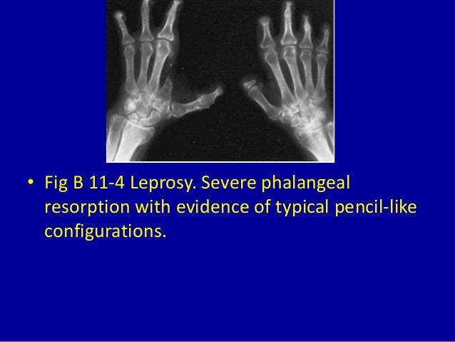11 erosion of multiple terminal phalangeal tufts (ACROOSTEOLYSIS)
