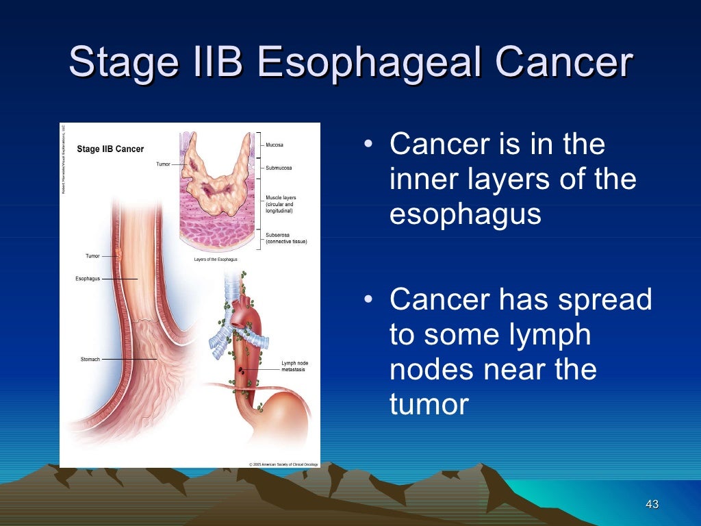 11 esophageal cancer