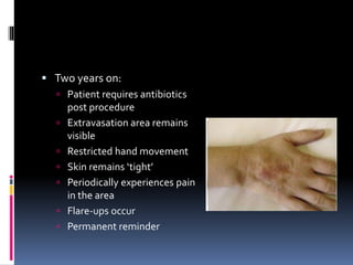 11 Extravasation.ppt