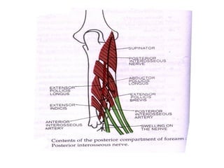 forearm extensor compartment | PPT